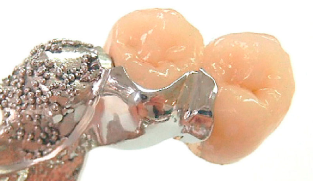 Modellguss - CS-Zahntechnik in Landsberg am Lech