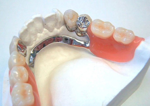 Modellguss - CS-Zahntechnik in Landsberg am Lech